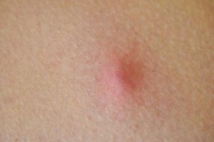 Drainage with Abscess Care - Emmaus Healthcare